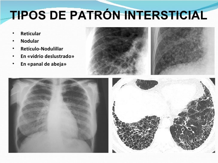 Diagnóstico diferencial patron intersticial2003