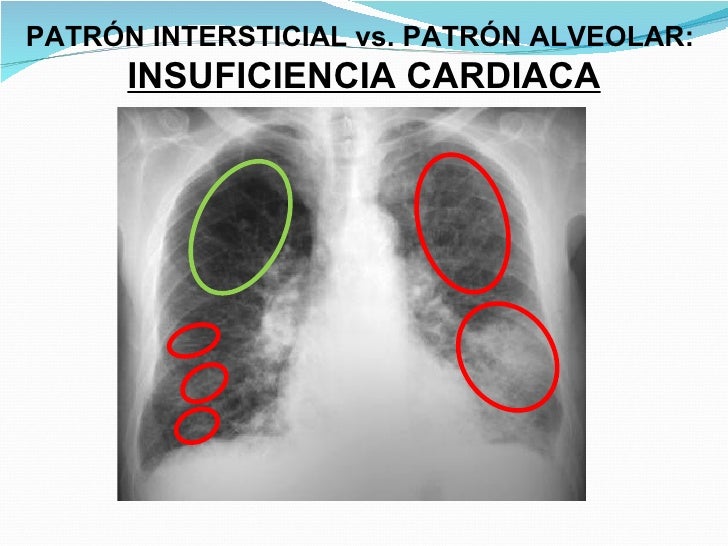 Tac Torax Patron Nodular Casos PEDiatricos On Line [Web PEDiatrica]
