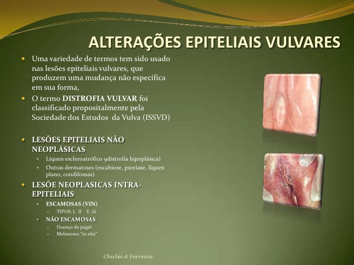 DiagnóStico E Tratamento Da Oncologia GinecolóGica