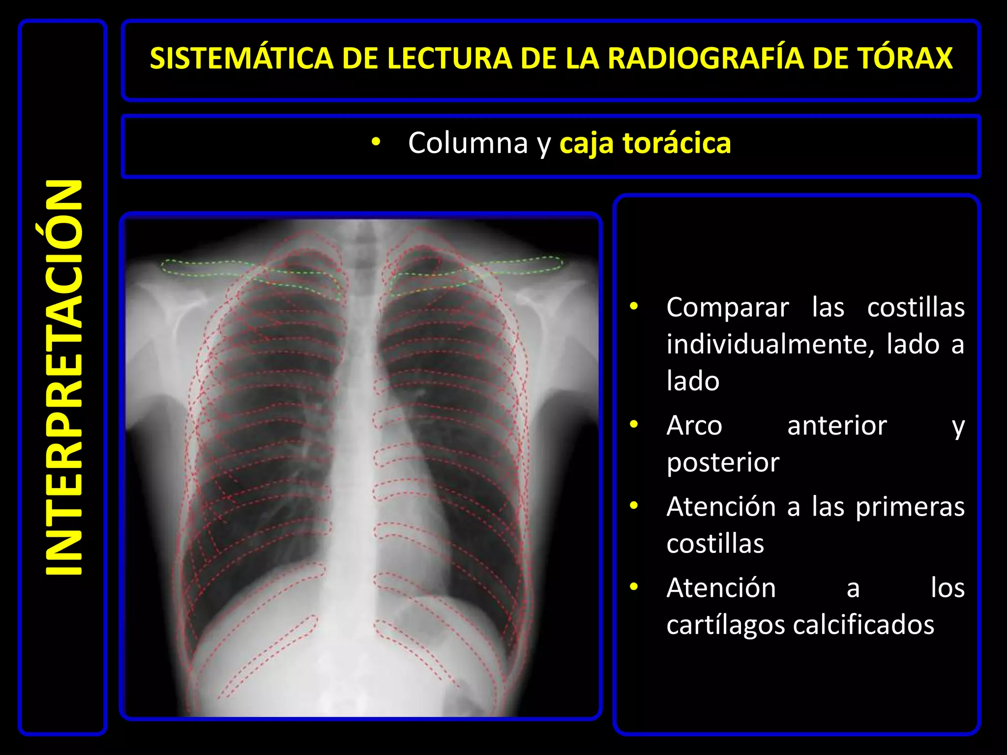 Diagnóstico por imágenes radiografía de tórax normal | PPTX