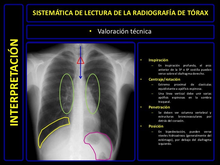 Diagnóstico por imágenes radiografía de tórax normal