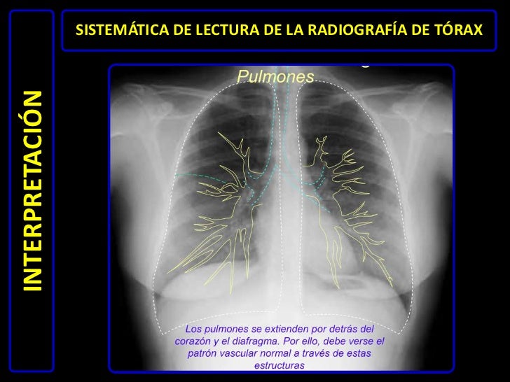 Diagnóstico por imágenes radiografía de tórax normal
