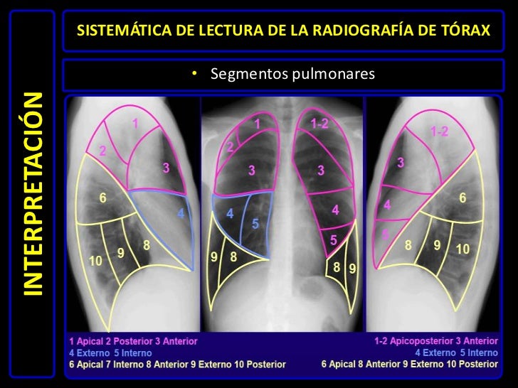 Radiografia De Torax Instavel