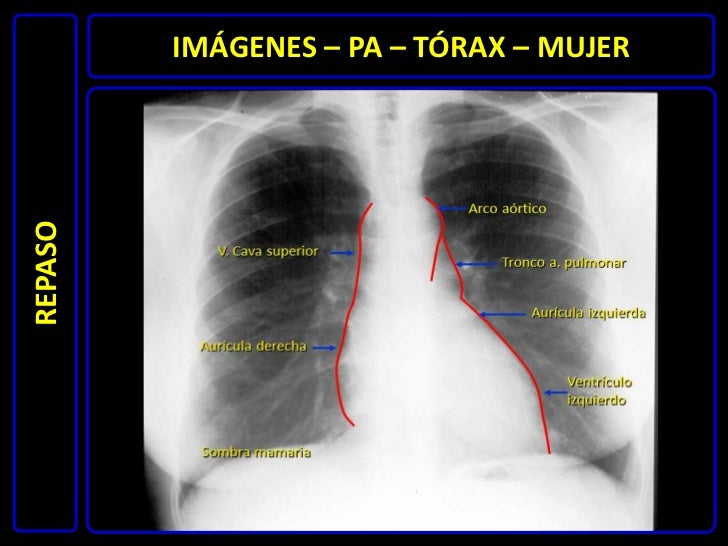 Diagnóstico por imágenes radiografía de tórax normal