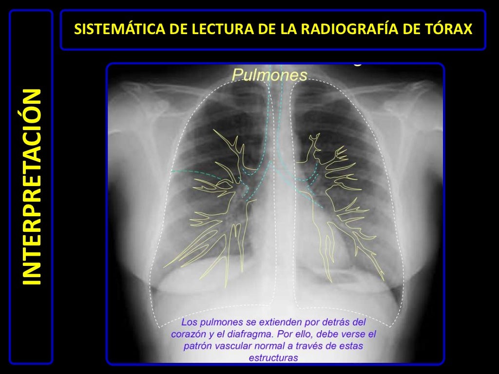 Diagnóstico por imágenes radiografía de tórax normal