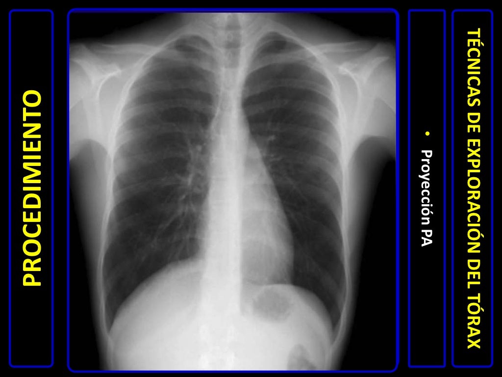 Diagnóstico por imágenes radiografía de tórax normal