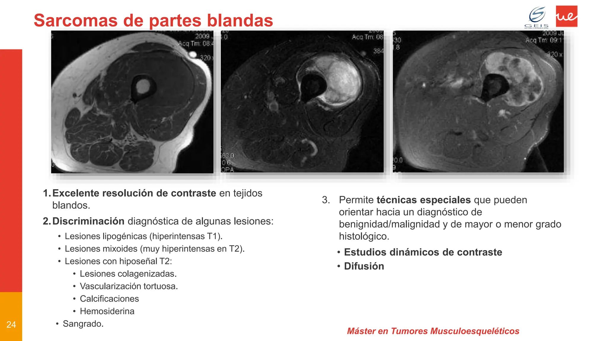 Diagnóstico radiologico de sarcomas clasificación | PDF