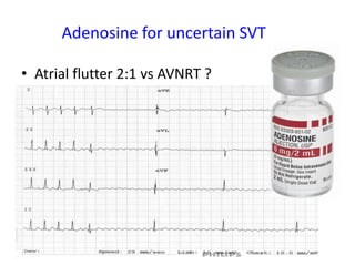 Diagonosis and management of Arrhythmia final Dr. Onn Akbar Ali ...