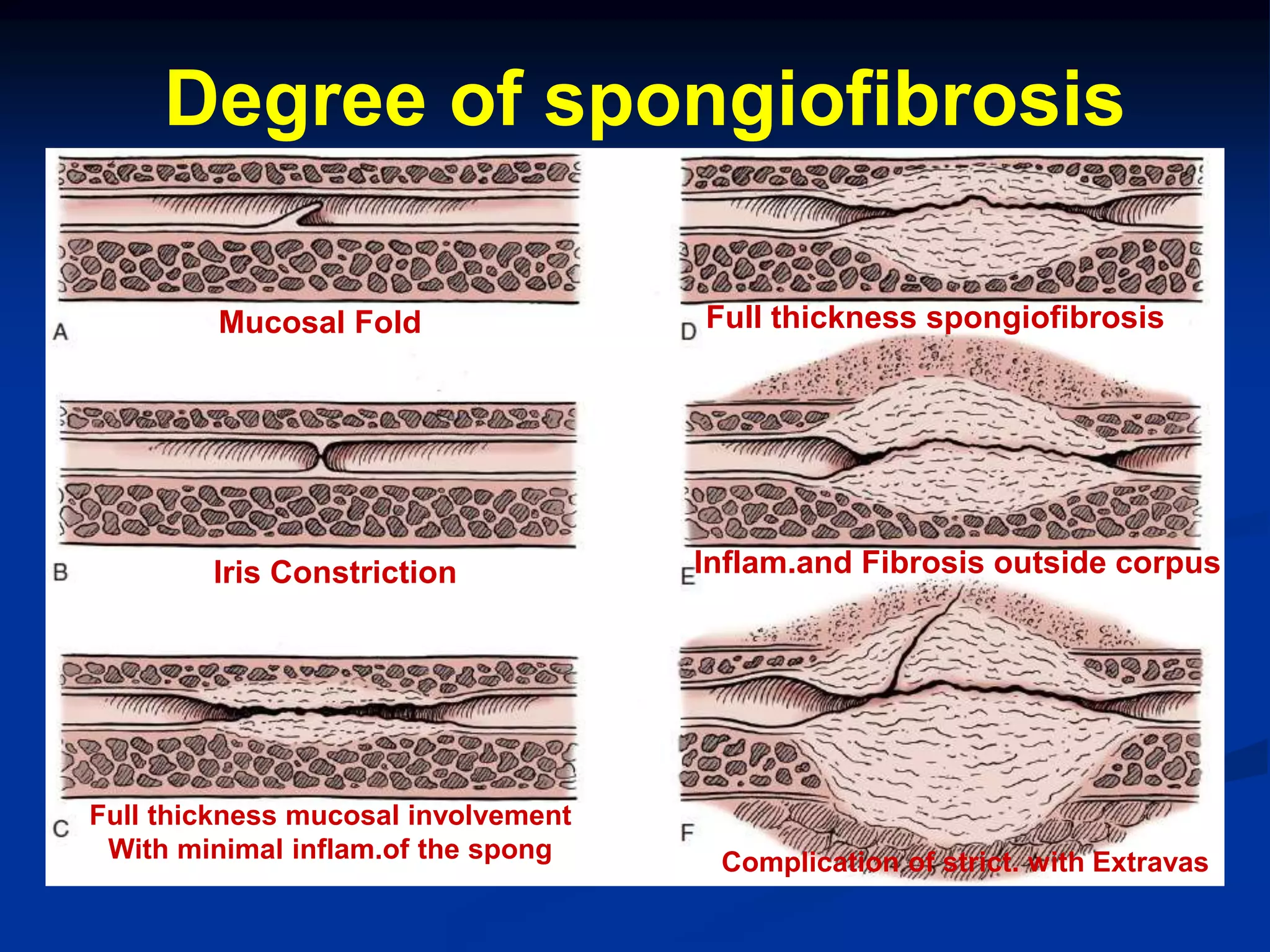 Diagosis of urethral stricture | PPTX