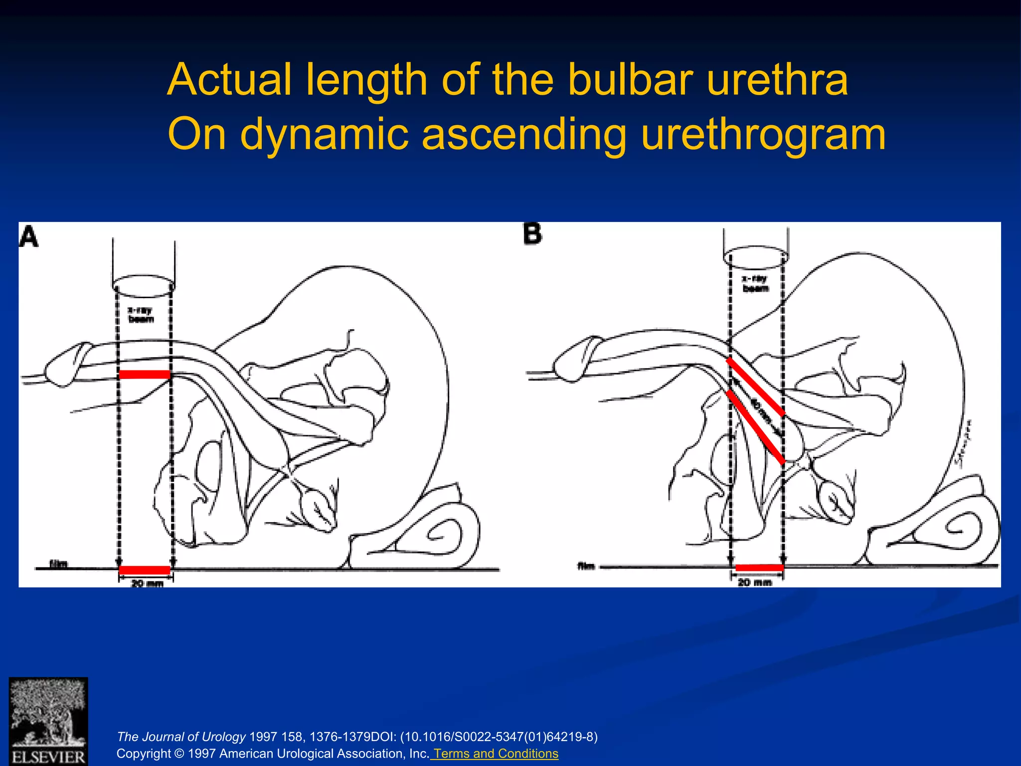 Diagosis of urethral stricture | PPTX