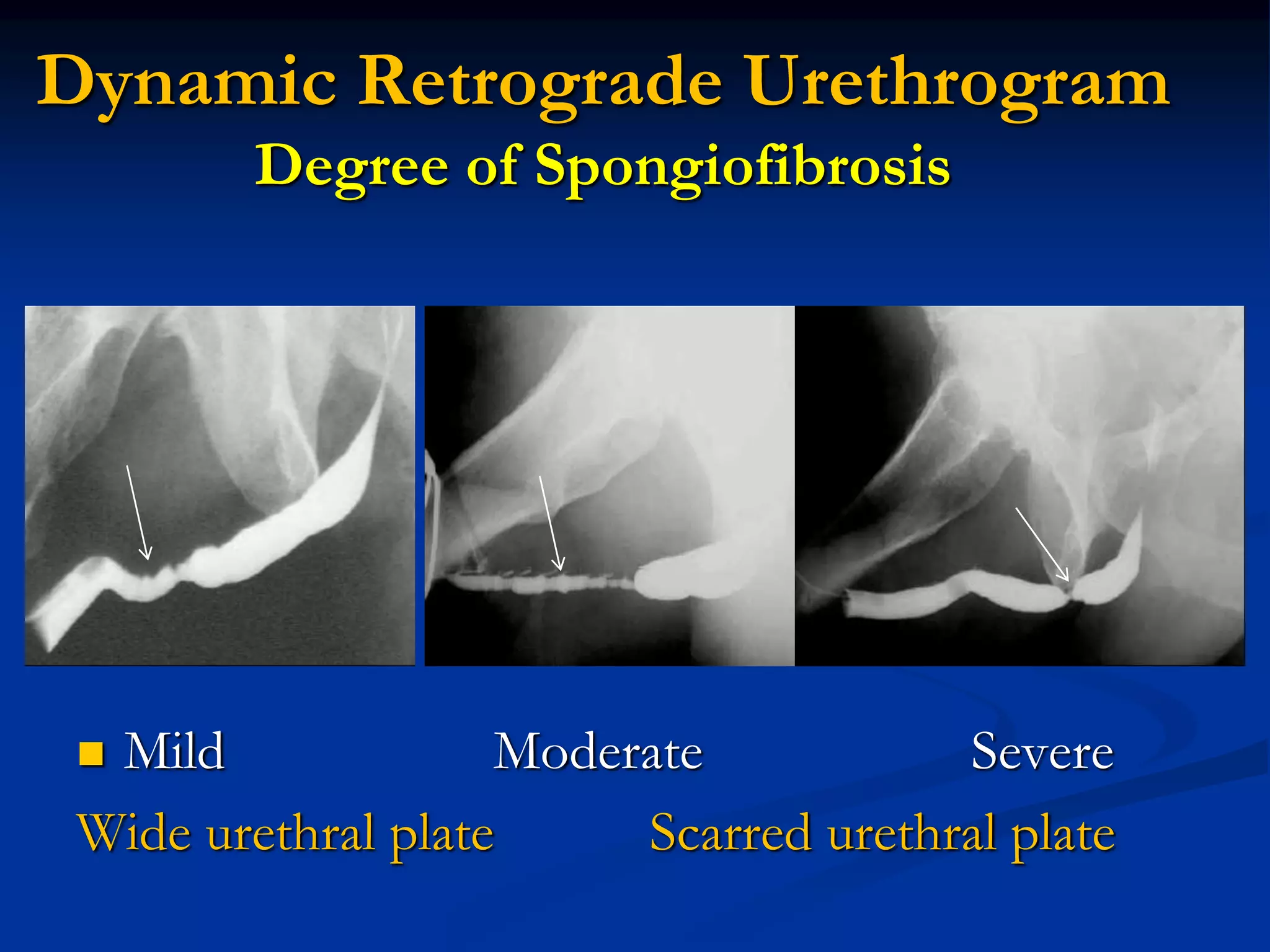 Diagosis of urethral stricture | PPTX