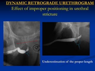 Diagosis of urethral stricture | PPTX