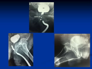 Diagosis of urethral stricture | PPTX