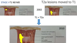 Diagrammatic representation of ca nasopharynx | PPTX
