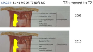 Diagrammatic representation of ca nasopharynx | PPT