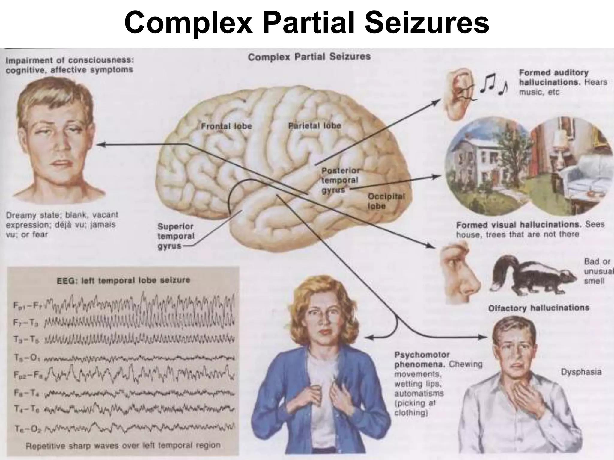 Diagrams-Eeg-Epilepsy.ppt