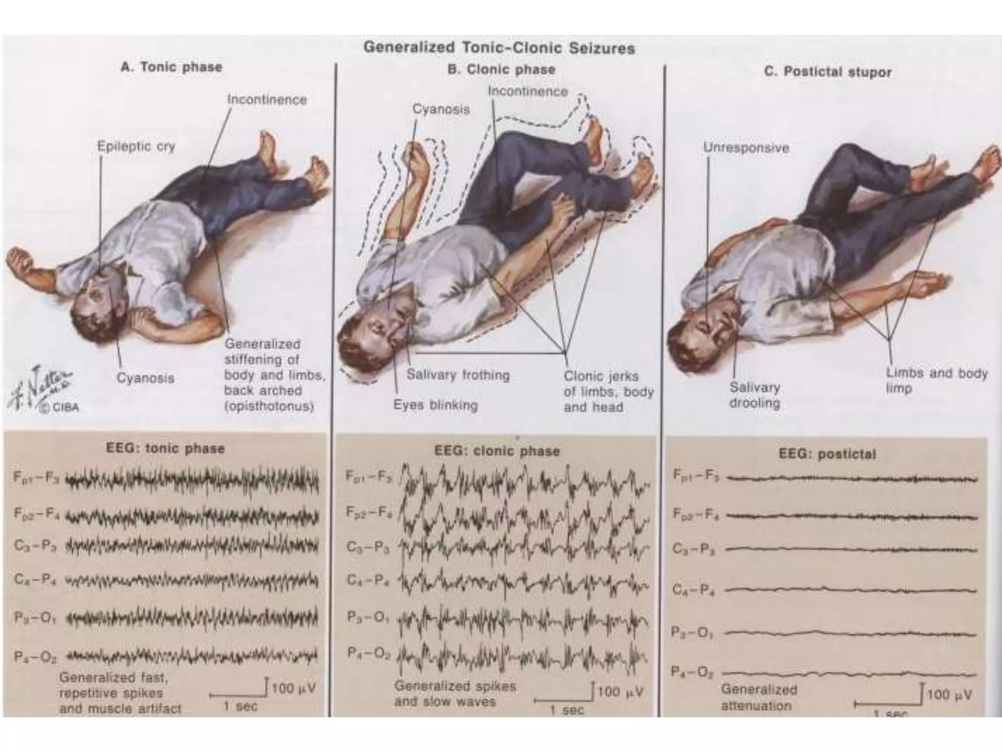 Diagrams-Eeg-Epilepsy.ppt