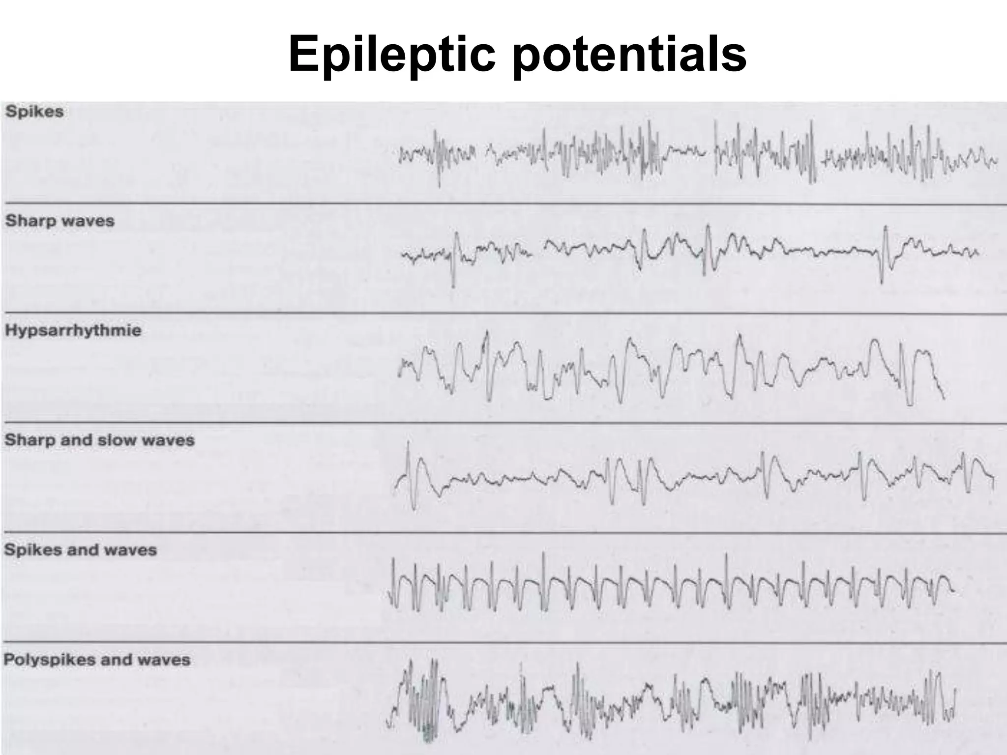 Diagrams-Eeg-Epilepsy.ppt