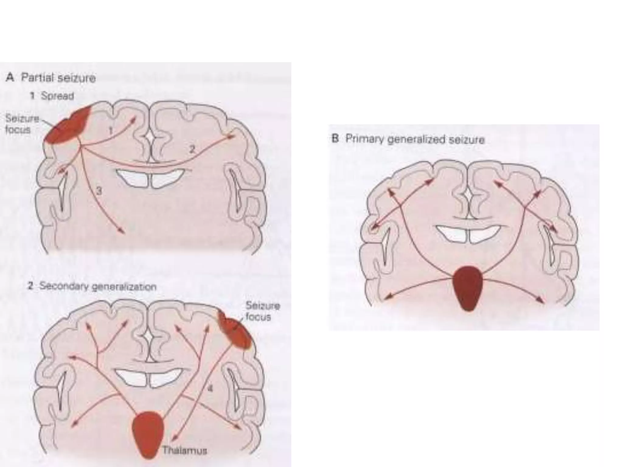 Diagrams-Eeg-Epilepsy.ppt