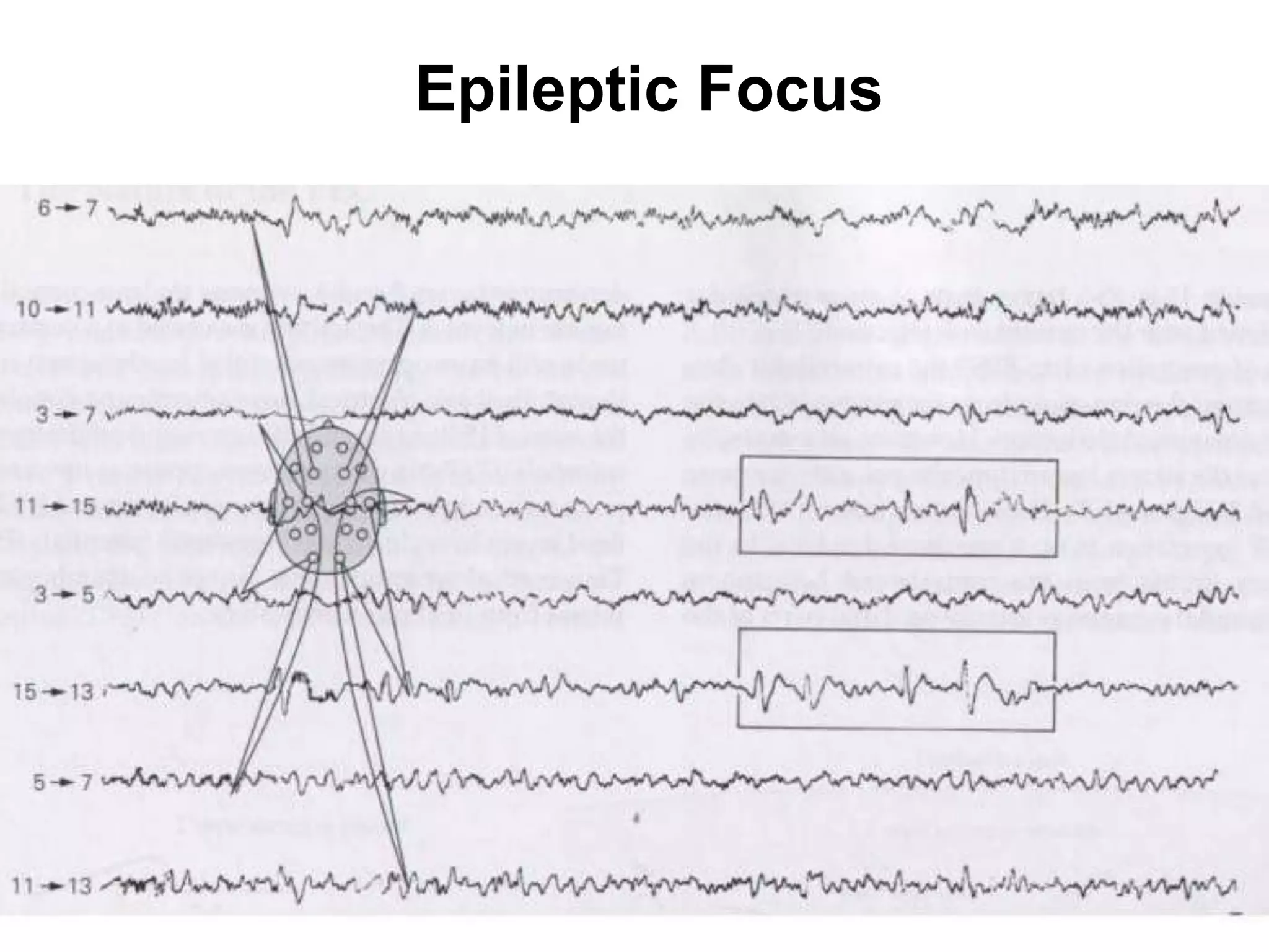 Diagrams-Eeg-Epilepsy.ppt