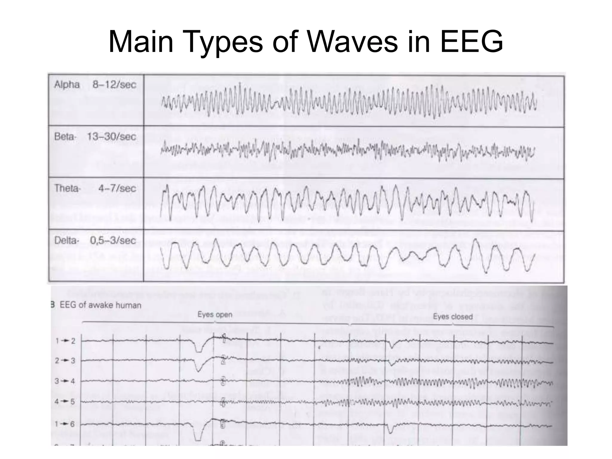 Diagrams-Eeg-Epilepsy.ppt