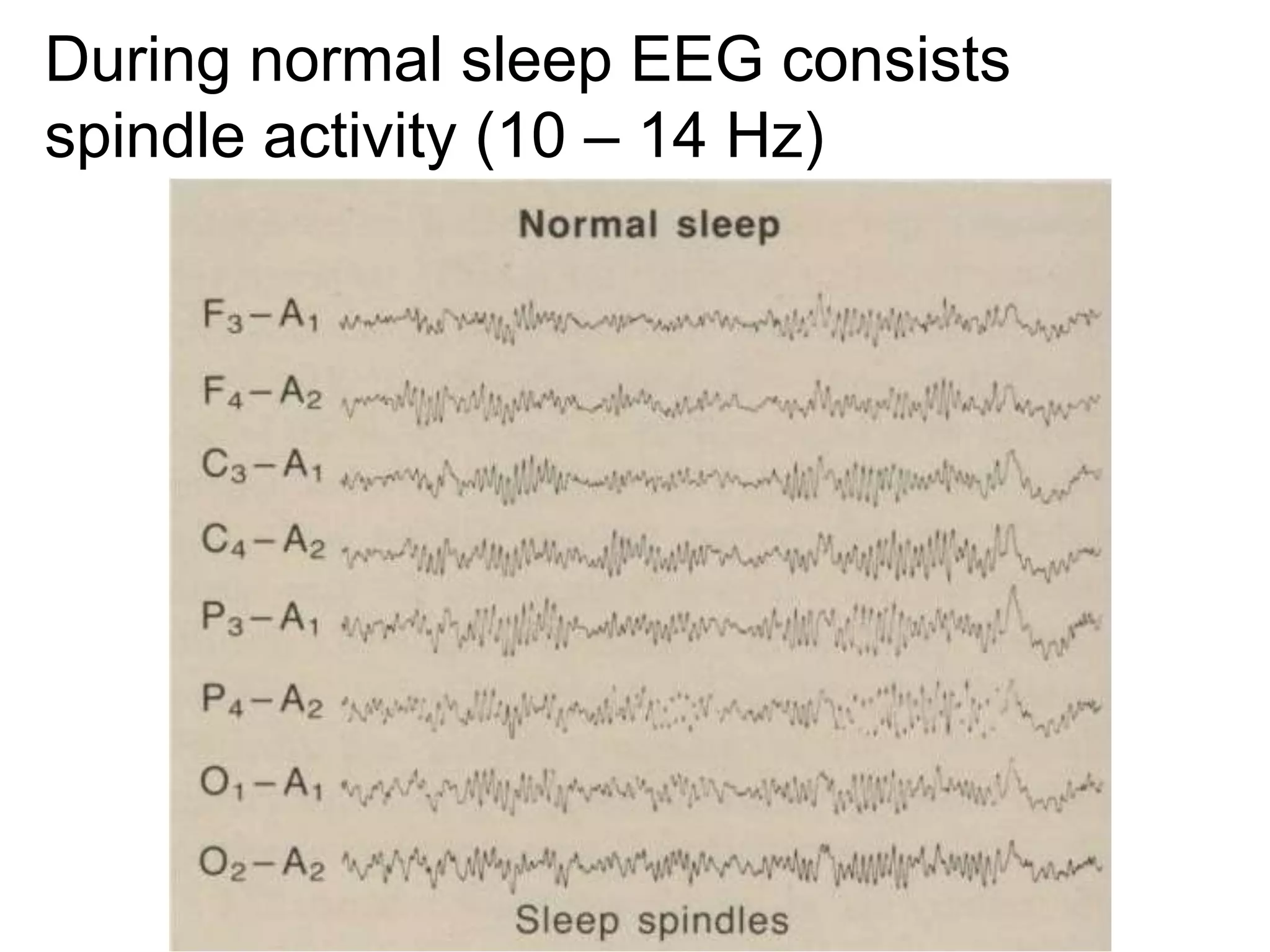 Diagrams-Eeg-Epilepsy.ppt