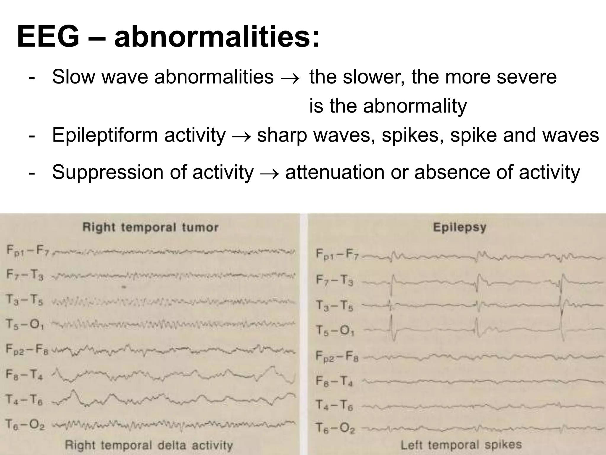 Diagrams-Eeg-Epilepsy.ppt
