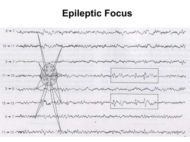 Diagrams-Eeg-Epilepsy.ppt | Brain and Nervous System Disorders ...