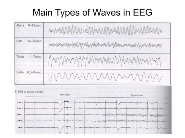 Diagrams-Eeg-Epilepsy.ppt | Brain and Nervous System Disorders ...