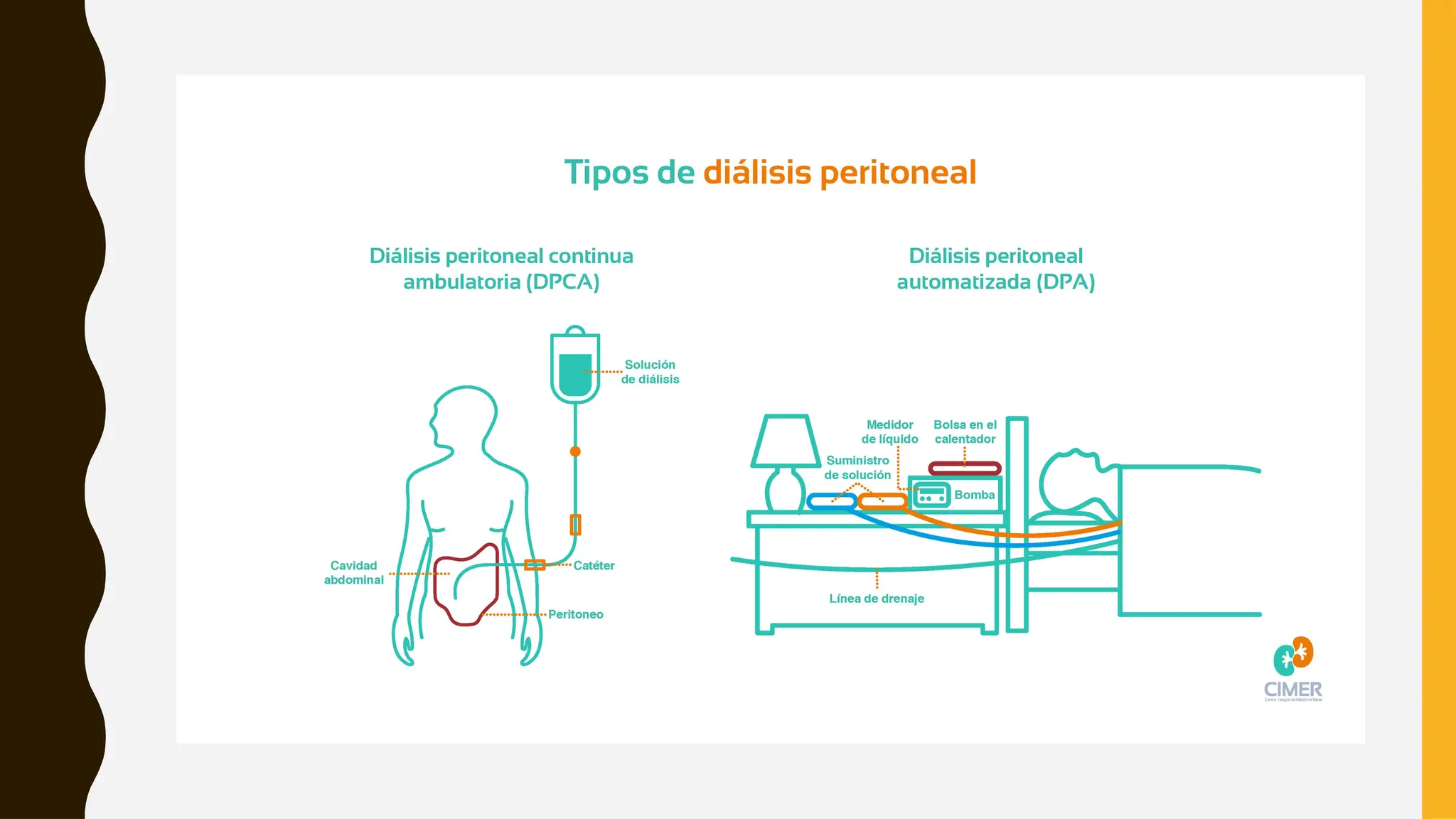 Dialisis peritoneal, generalidades y esquemas | PPTX