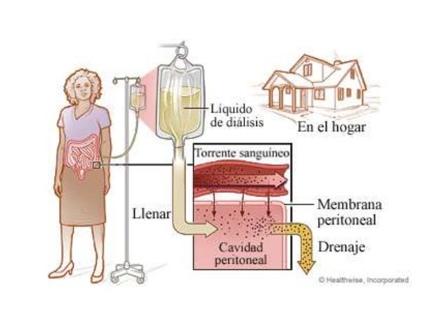 Dialisis peritoneal