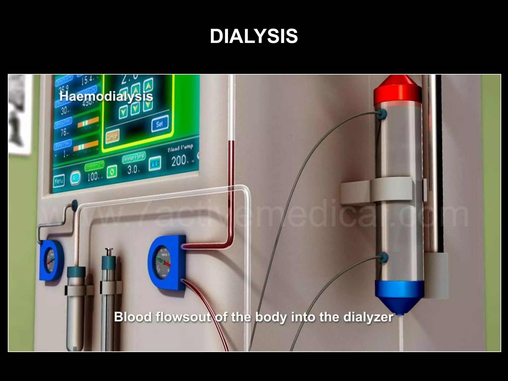 Dialysis | PPTX