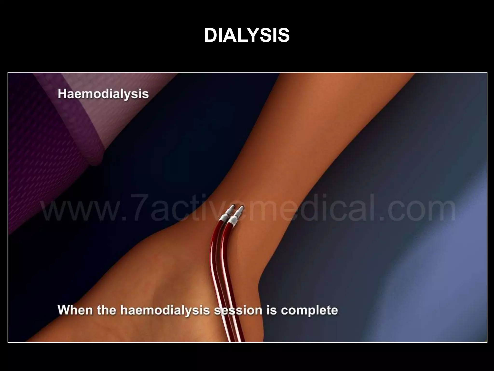 Dialysis | PPTX