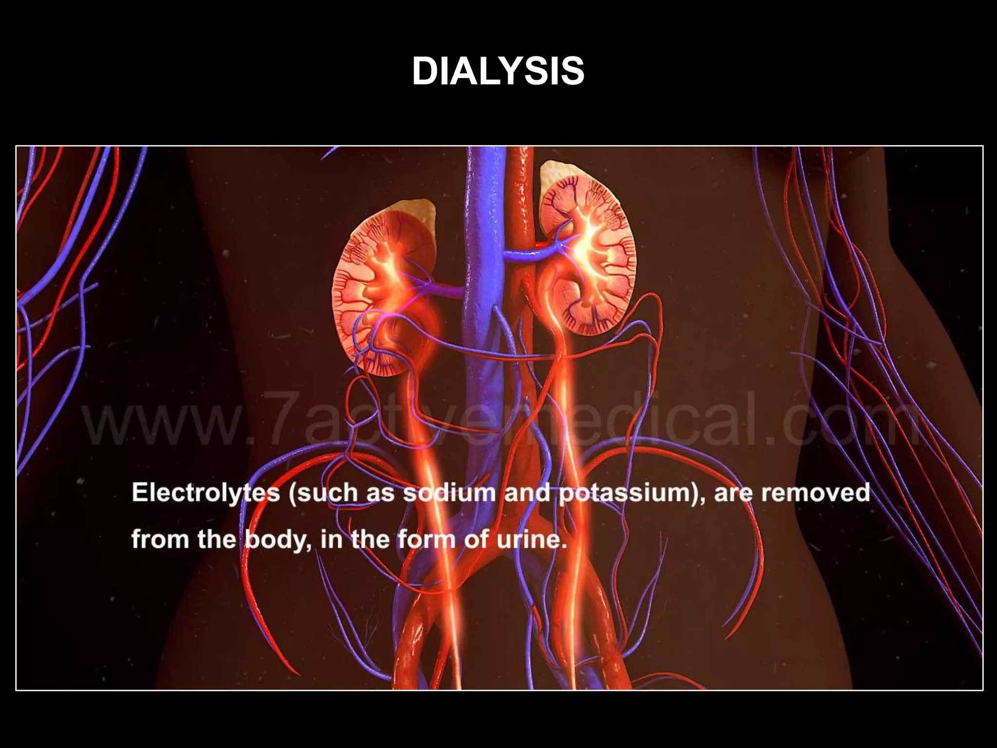 Dialysis | PPT