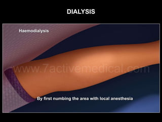 Dialysis | PPTX