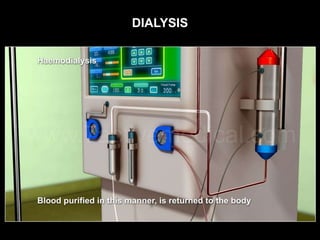 Dialysis | PPTX