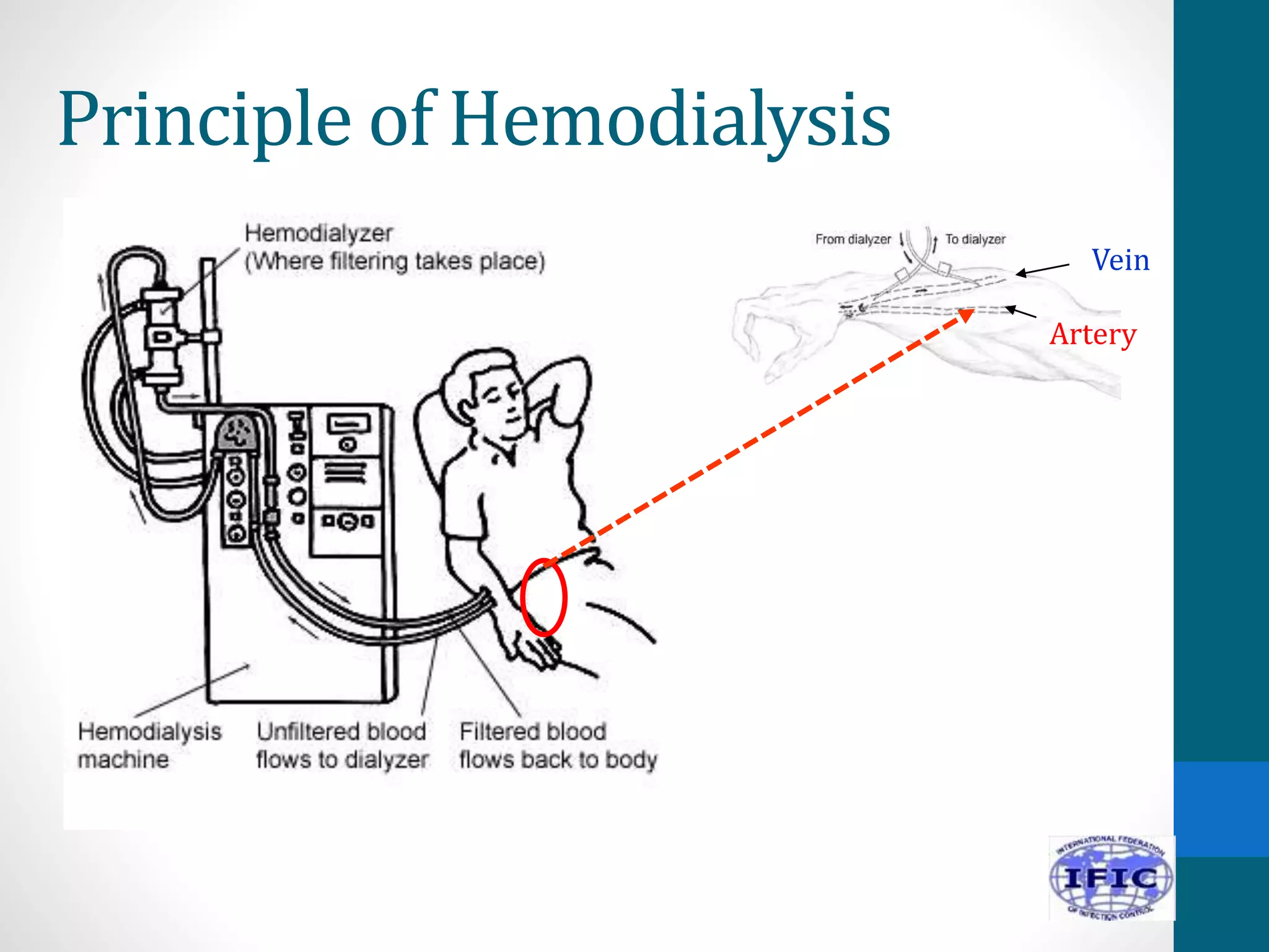 Dialysis | PPTX
