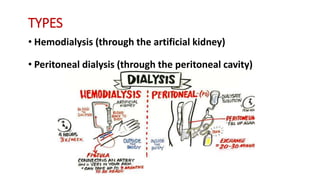 Dialysis | PPTX