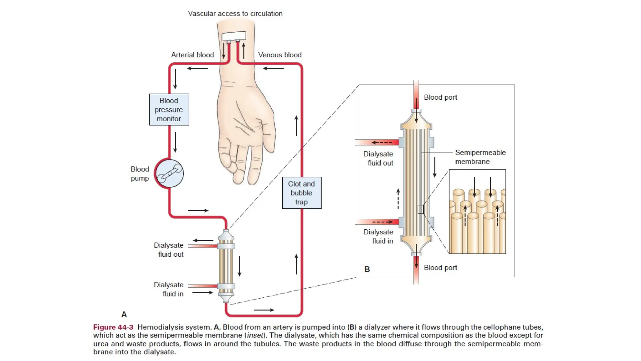 DIALYSIS- HEMODIALYSIS AND PERITONEAL DIALYSIS, INDICATIONS, PRINCIPLES ...