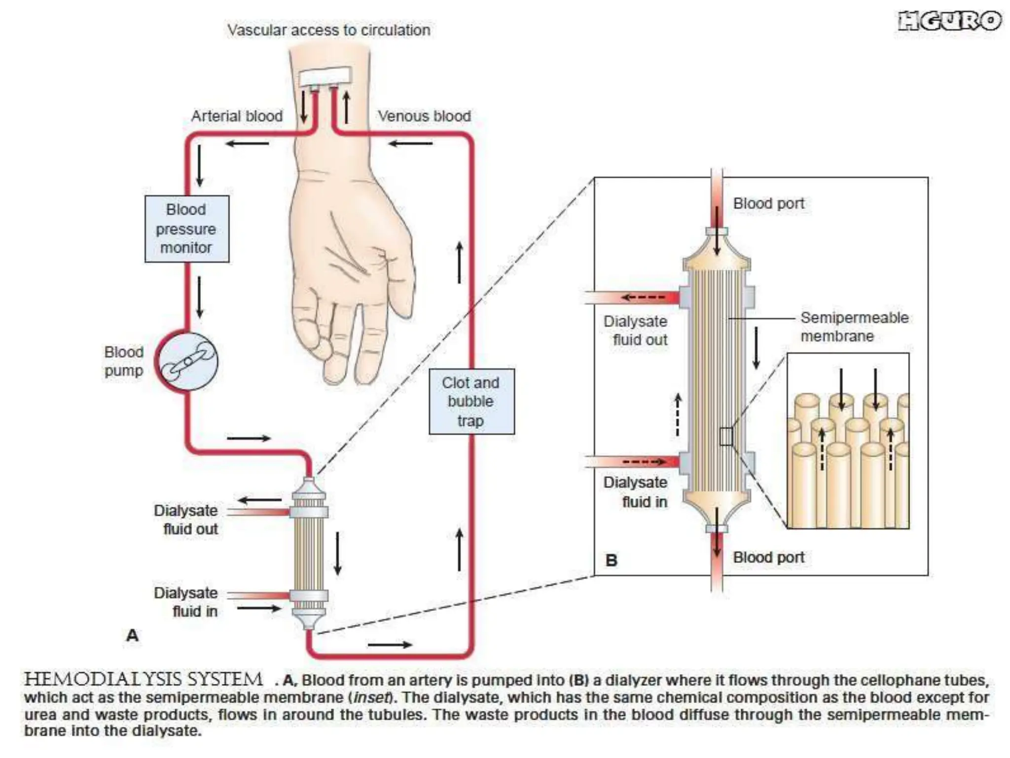 DIALYSIS2 Hemodialysis peritoneal d.pptx