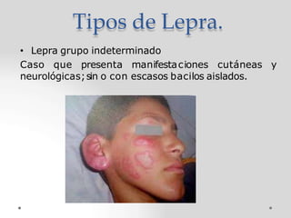 DIA MUNDIAL DE LA LUCHA CONTRA LA LEPRA.pptx