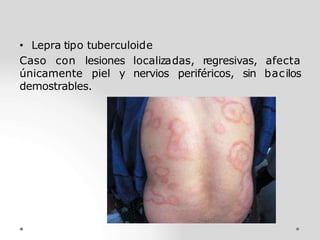 DIA MUNDIAL DE LA LUCHA CONTRA LA LEPRA.pptx