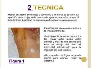 Tubo de toracostomia | PPTX