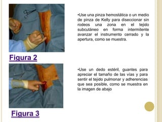 Tubo de toracostomia | PPTX