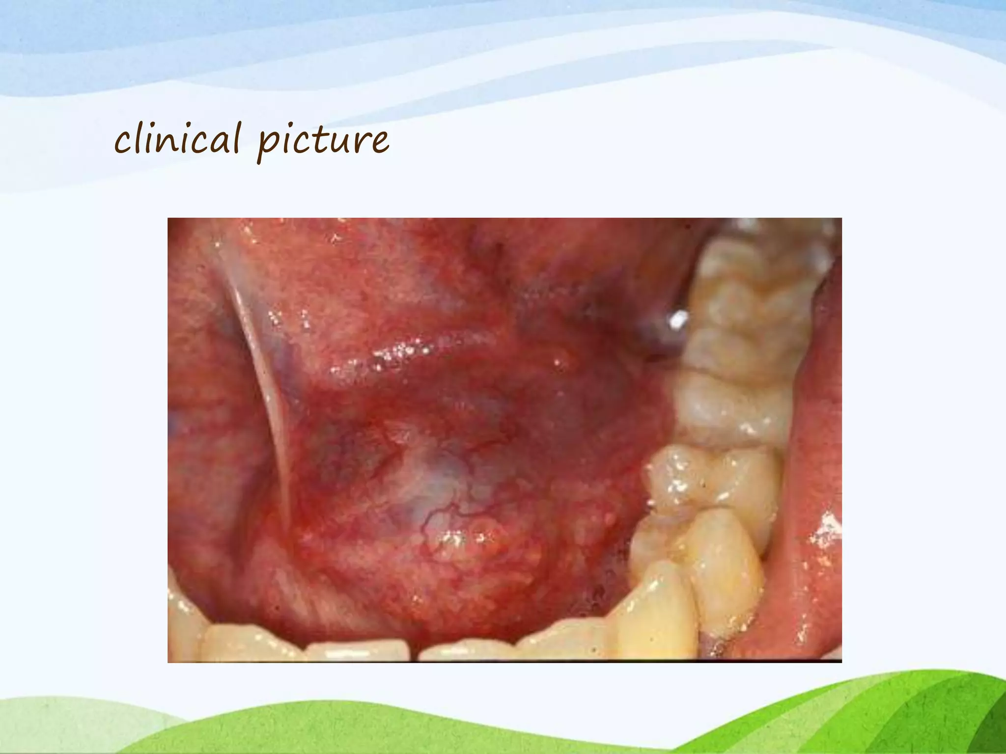 most common dental cysts in radiology | PPT