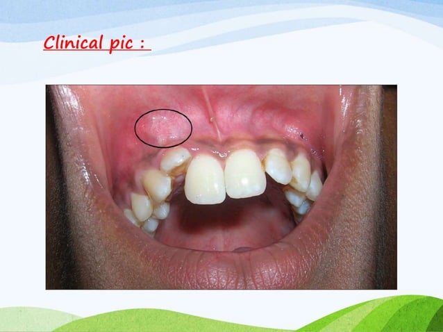 most common dental cysts in radiology | PPT