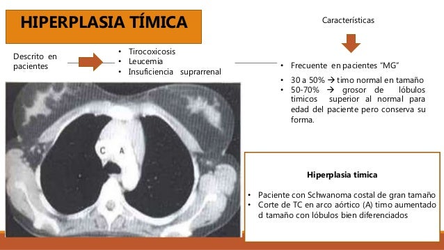 Diagnostico por imagen, Lesiones del Mediastino Anterior