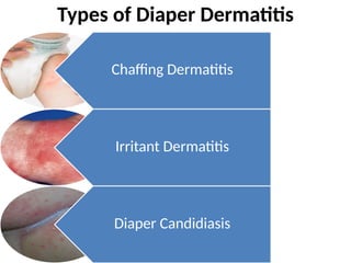 Pediatric Diaper Dermatitis (final Year) | PPT