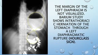 Traumatic Injuries of Diaphragm | PPTX