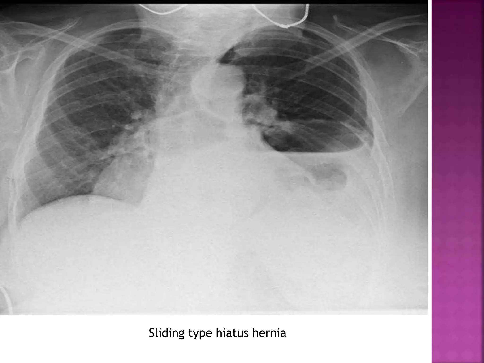 Diaphragmatic Disorders | PPTX